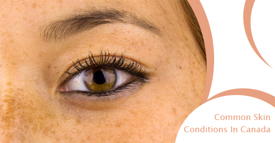 What Are The Most Common Skin Conditions? | Centre for Dermatology